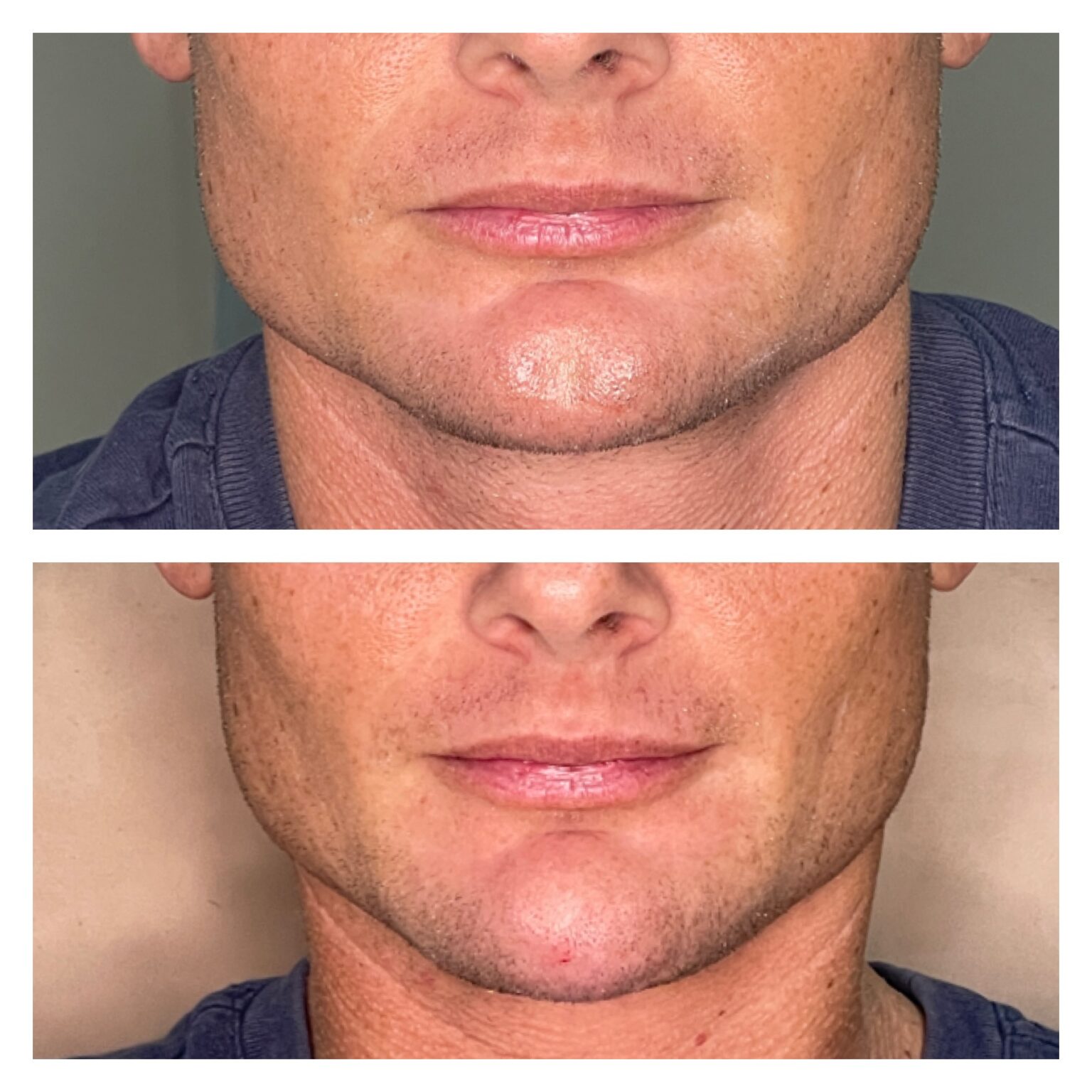 Chin Dimpling Treatment Volumiser | Brisbane | Hamilton Skin Clinic ...